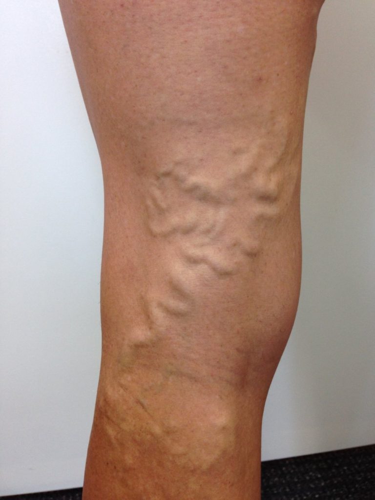 How Are Varicose Veins Diagnosed Top Varicose Vein Treatment NYC how-are-varicose-veins-diagnosed-top-varicose-vein-treatment-nyc