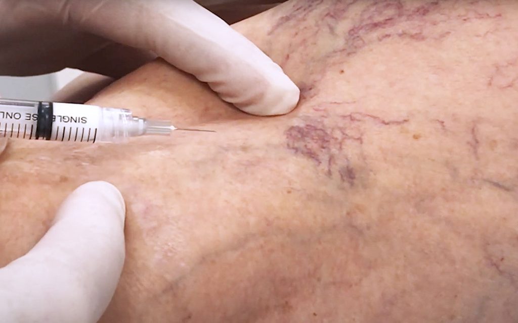 Sclerotherapy: A Minimally Invasive Treatment for Vein Issues - Top ...